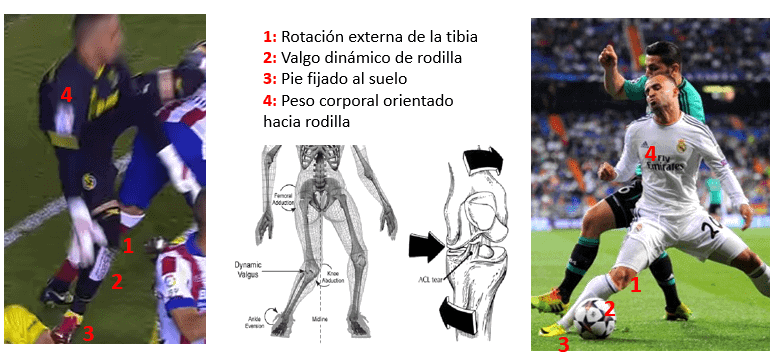 Rotura de Ligamento Cruzado Anterior【1 Guía completa】