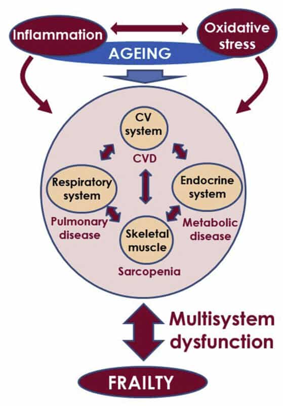Síndrome de fragilidad: 3 aspectos clave que debes saber