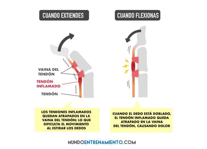 Dedo en gatillo - ¿Tiene solución?【1 Guía completa】