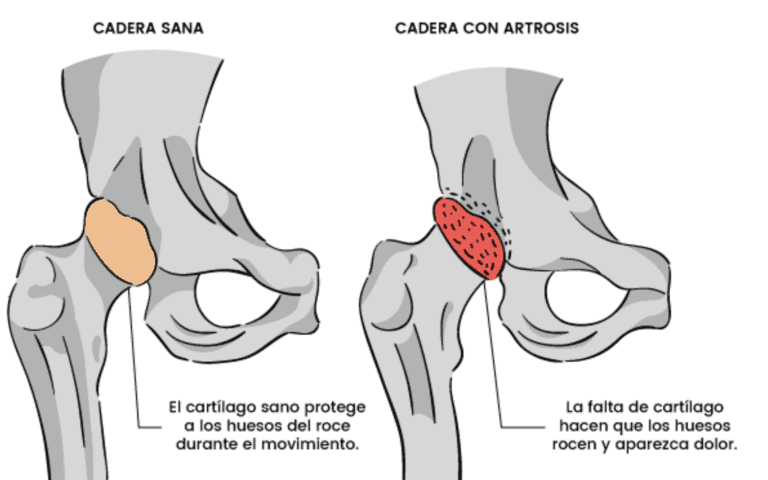 Dolor de cadera - ¿Por qué se produce?【1 Guía completa】