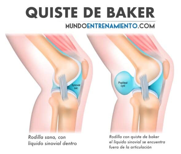 Quiste de Baker - ¿Qué es y cómo se trata?【1 Guía rápida】