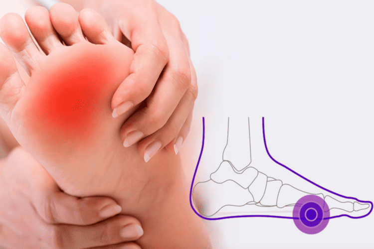 Metatarsalgia -【¿Qué es y cómo podemos prevenirla?】