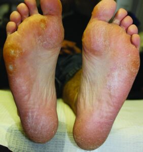 Hongos en los pies: Tipos, diagnóstico, tratamiento
